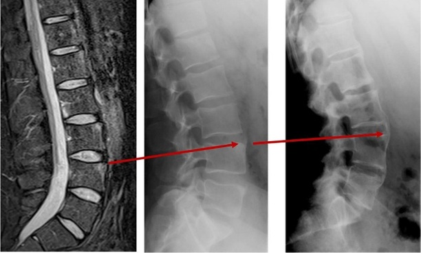 Behandling af rygsøjlegigt